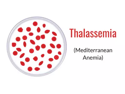 Thalassemia (Mediterranean anemia): Causes, and treatment